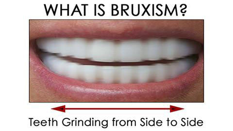 What is Bruxism and Is It Bad For My Teeth? | Brux Night Guard